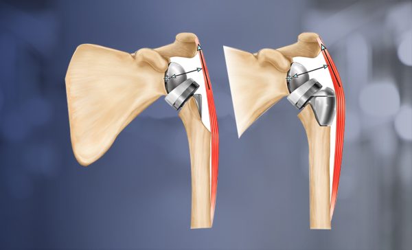 Reverse Shoulder Replacement – Flex Knee And Shoulder Clinic